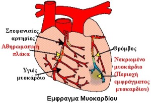 Τσιαντής Νικ. Ιωάννης, MD, MSc | ΟΞΥ ΕΜΦΡΑΓΜΑ ΤΟΥ ΜΥΟΚΑΡΔΙΟΥ
